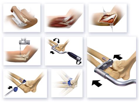 Elbow Surgical Technique Holladay Graphics