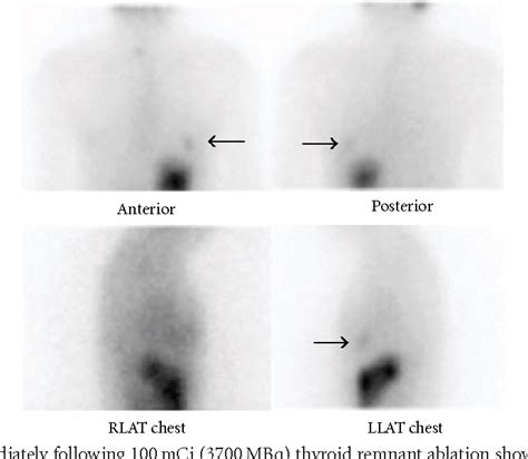 Figure 1 From Focal Bronchiectasis Causing Abnormal Pulmonary Radioiodine Uptake In A Patient