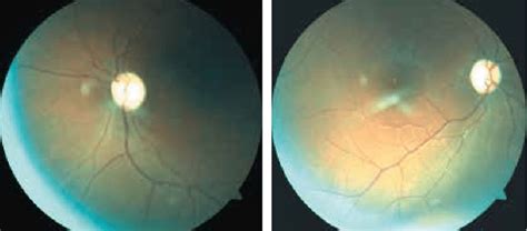 Funduscopy Of Patient 2 Showing Bilateral Optic Atrophy And Normal