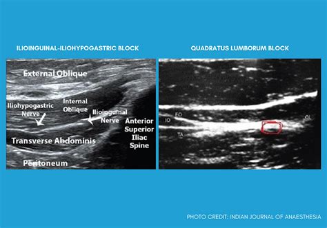 Quadratus Lumborum Vs Ilioinguinal