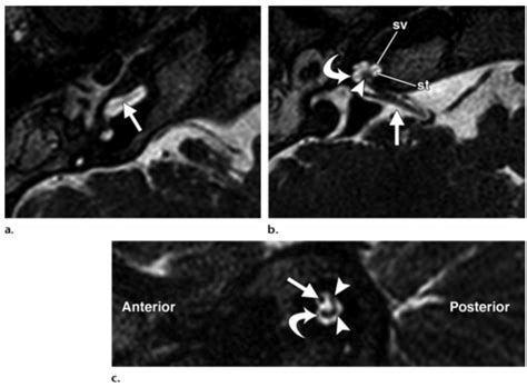 High Resolution MR Images Obtained With Heavy T2 Weighting Show The