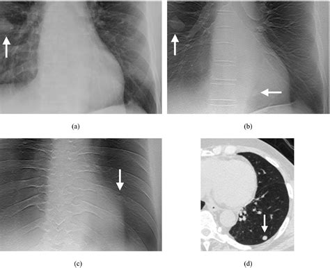 Figure 1 From Digital Tomosynthesis Of The Chest For Lung Nodule