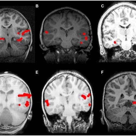 Receptive Language Mapping With Meg With And Without Sedation Download Scientific Diagram