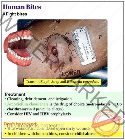Human Bites Medicine Keys For MRCPs