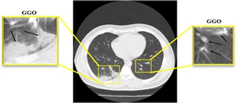 Ct Scan Results Of A Virus Infected Lung Showing The Presence Of Ggo On Download Scientific