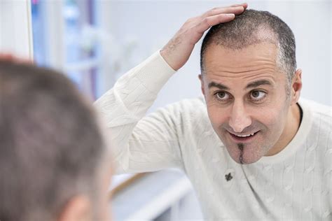 Why Do Men Go Bald
