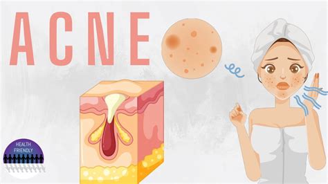 Acne Youtube
