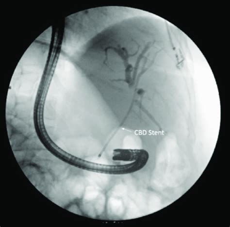 Fluoroscopy Imaging Confirming Common Bile Duct Stent Placement Cbd