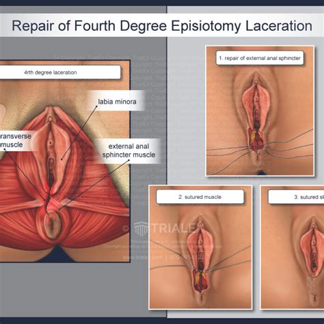 Medical Legal Exhibits Legal Animations And Trial Graphics Tria