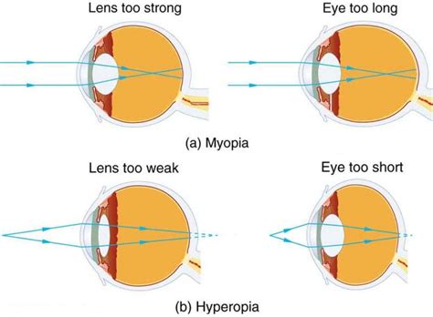 Correction Of Various Eye Vision Disorders By Lens Hyperopia Myopia And Astigmatism Artofit