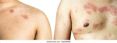 Mild Ringworm On Chest