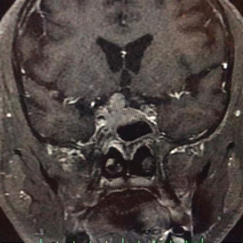 T1 Weighted Mri With Contrast Of The Lesion In The Sellar Region With