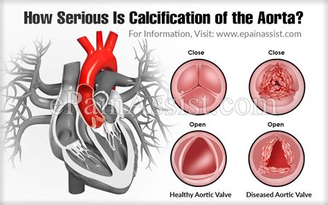 How Serious Is Calcification Of The Aorta