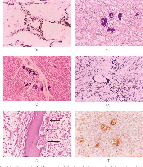 Figure 1 From Pathogenesis Of Metastatic Calcification And Acute