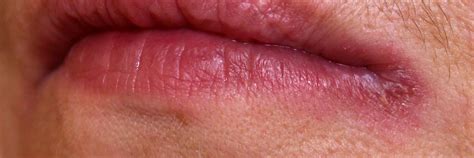 Angular Cheilitis Vs Cold Sore