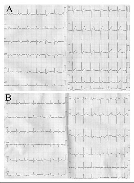 electrocardiogram ecg showing a normalized st segment deviation while