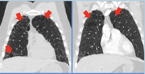Microscopic Polyangiitis Mpa Presenting As Interstitial Lung Disease