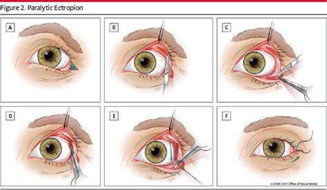 Figure 1 From Single Stage Repair Of Paralytic Ectropion Using A Novel