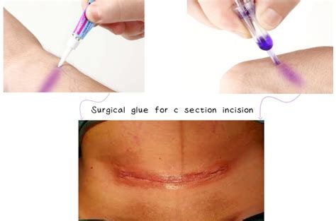 C Section Cesarean Section Everything You Need To Know Perfectseal