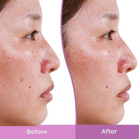 Differin Dark Spot Correcting Serum Review Clearer Skin
