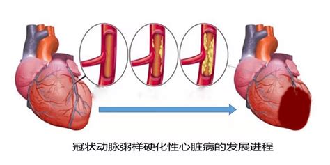 健康科普 冠心病可防可治 控制