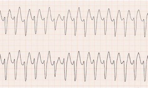 Difference Between Monomorphic And Polymorphic Ventricular Tachycardia