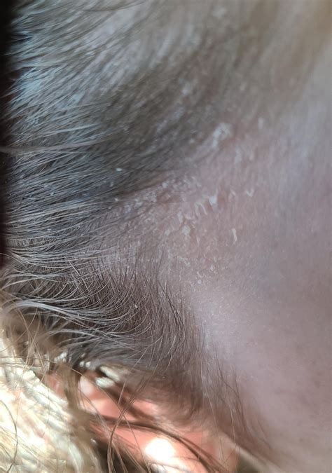 Ive Had This Flakey Red Rash Thing Across My Whole Hairline For