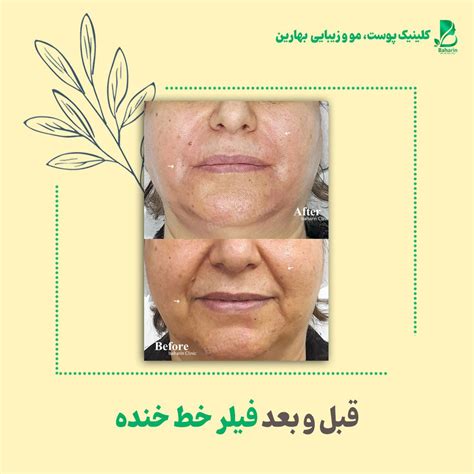 قیمت فیلر یا ژل خط خنده؟ مرداد ماه ۱۴۰۲ ️ کلینیک بهارین