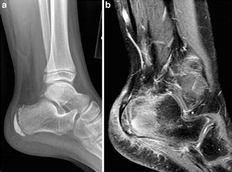 Calcaneal Apophysitis Mri