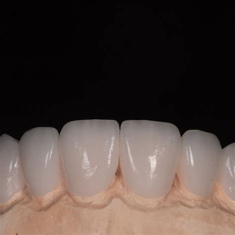 Feldspathic Veneers Vs Emax Whats The Difference — Styledent Full Arch Dental Lab In Orlando