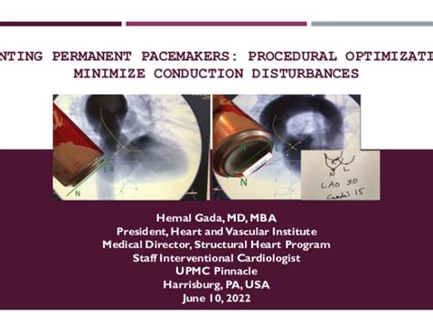 Preventing Permanent Pacemakers Procedural Optimization To Minimize Conduction Disturbances