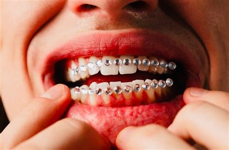 Better Braces Simple Techniques To Improve Your Orthodontic Experience