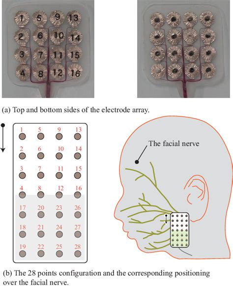 Figure 1 From Selective Facial Nerve Stimulation With An Array Electrode Semantic Scholar
