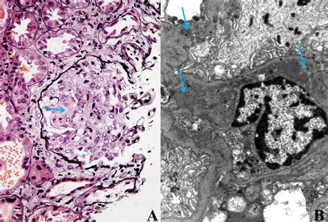 A Cellular Crescent With Necrosis Arrow In Glomerulus Jones