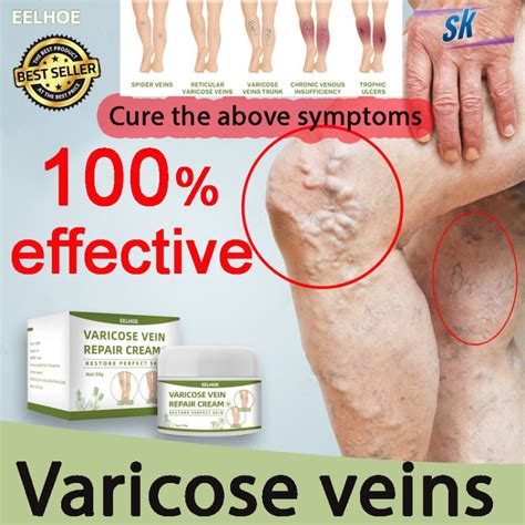 Varicose Veins Repair Cream G Promote Blood Circulation Veins Relieve Leg Bump Pain Earthworm