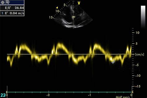 Medial Early Diastolic Mitral Annular Velocity E′ Measured By