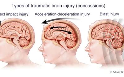Horizon TBI Brain Center Neurology TBI Testing