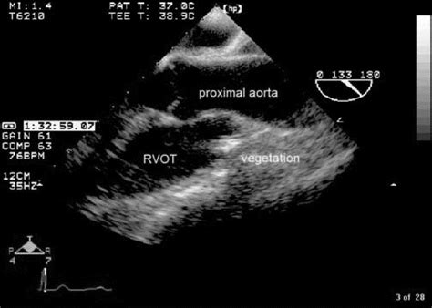 Pulmonic Valve Endocarditis In A Normal Heart Journal Of The American