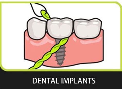 Thornton Bridge And Implant Floss Kleenteeth