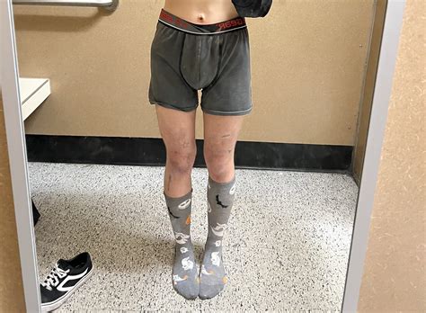 Why Are My Thighs Itchy And Burning Printable Templates Protal