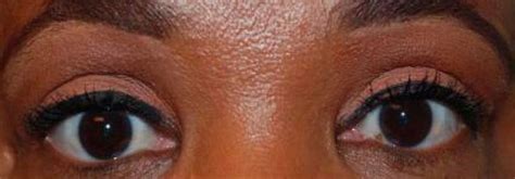 Before And After Ptosis Repair In Atlanta Ga Oculus