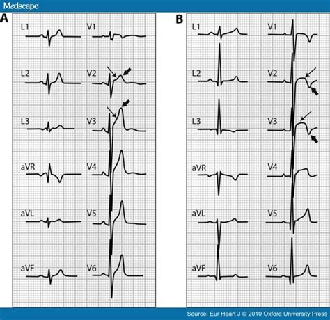 Benign Early Repolarization