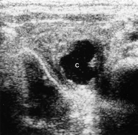 Gartners Duct Cyst Ultrasound