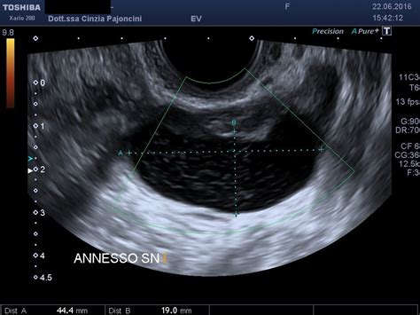 Cisti Ovariche Sintomi Diagnosi E Cura Dott Ssa Pajoncini