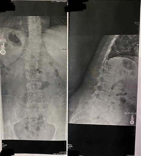 I Have Absolutely No Clue Whats Going On Here See Comment Rscoliosis