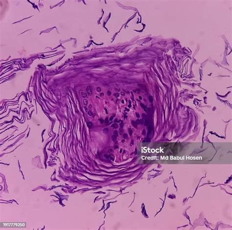 Mature Cystic Teratoma Ovarian Cyst Biopsy Show Cyst Wall Of Skin And