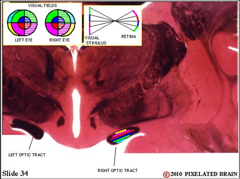 Pixelated Brain Module 11 Section 5 The Optic Tract