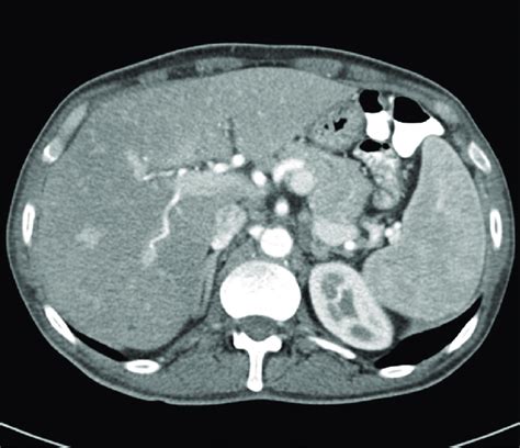 Ct Abdomen With Contrast Showing Hepatosplenomegaly With Multiple