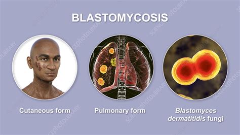 Clinical Presentations Of Blastomycosis 3d Illustration Stock Image