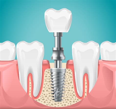 Dental Implant